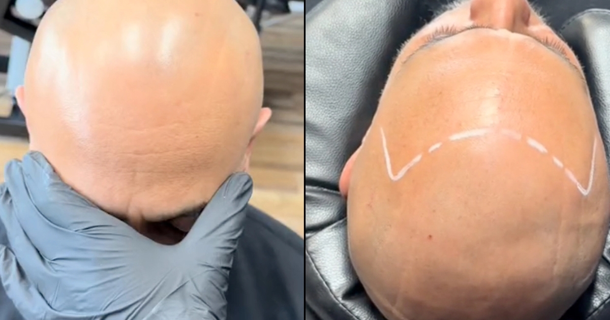 Mannen får tatovert "hår" på skallet hodet: Folk er i sjokk over resultatet