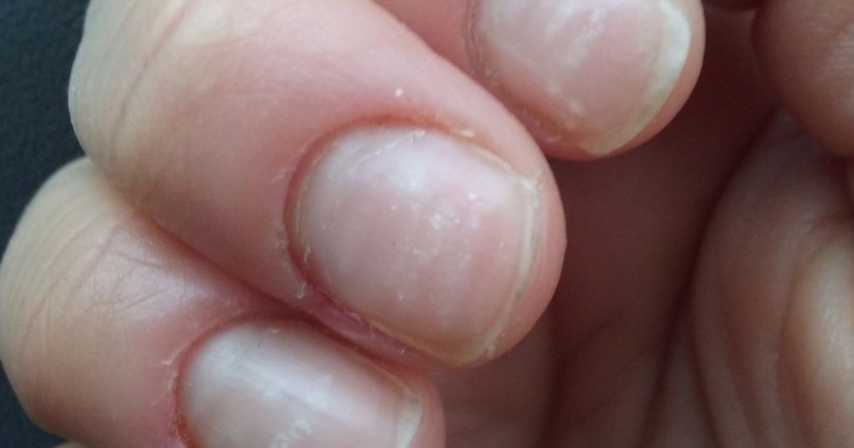 Mange danskere har 'hvide pletter' på neglene: Hudlæge forklarer, hvad ...