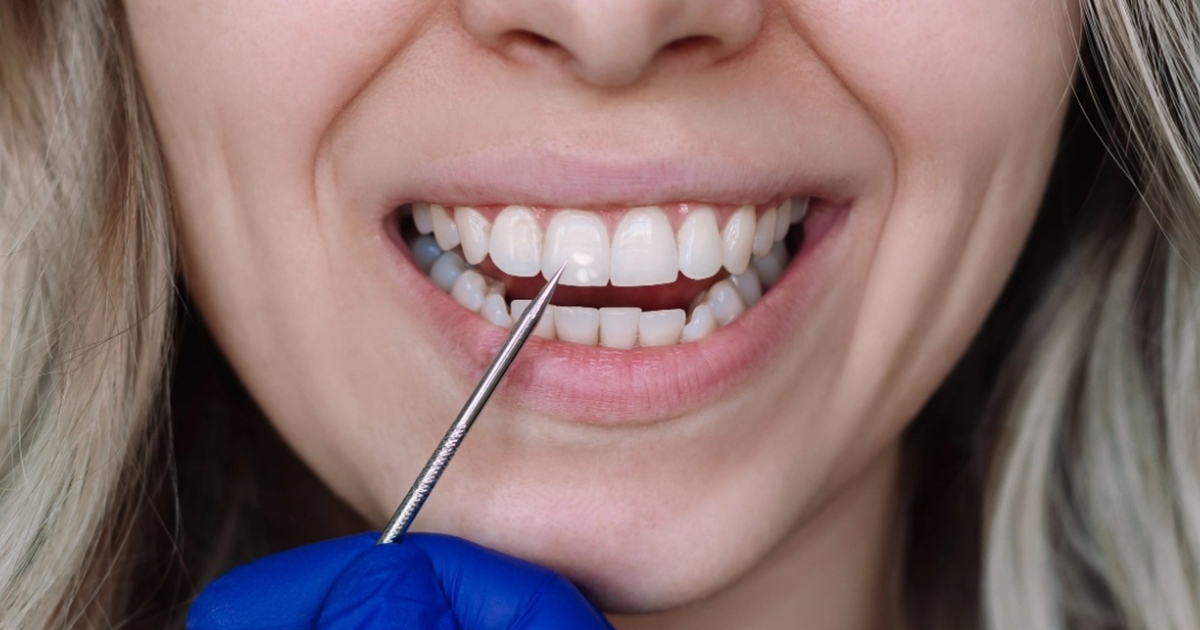 Ekspert: Det er derfor tennene dine blir gule