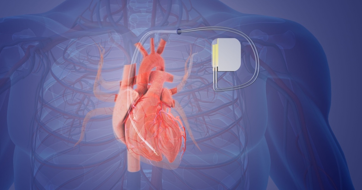 Advances in Pacemaker Technology: A New Battery-Free Design