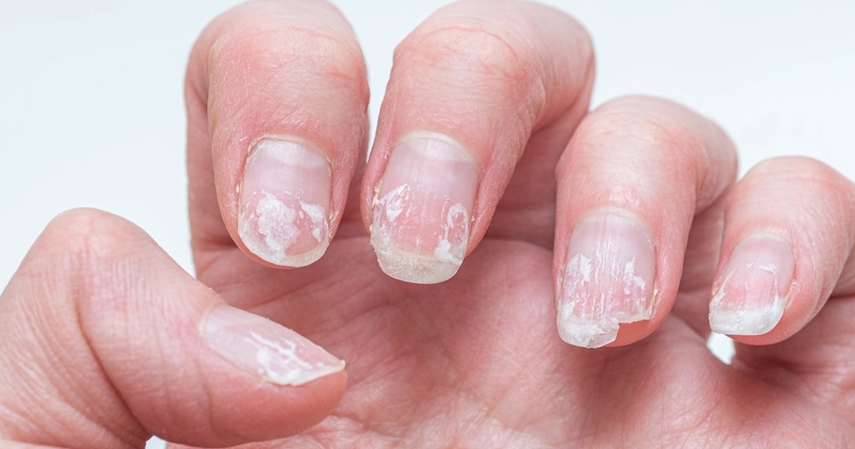 Do You Have Ridged Nails? Here’s What They Might Be Telling You About ...