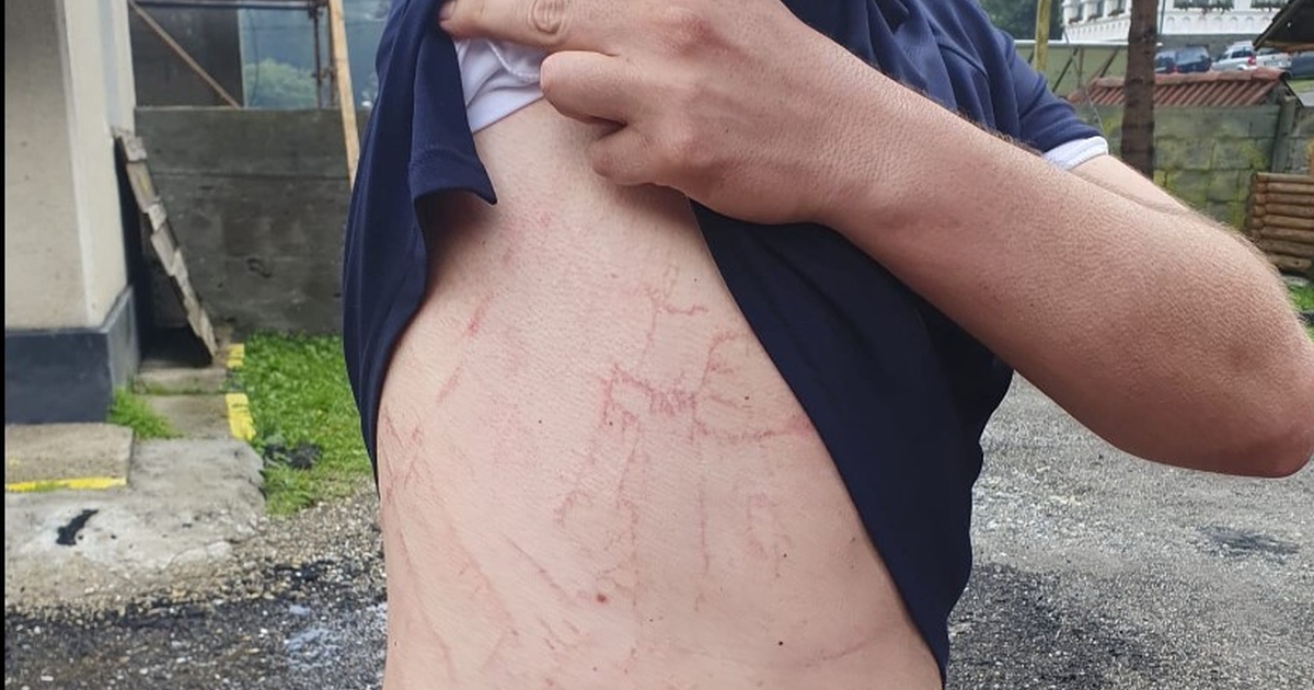 Man Survives Lightning Strike and Shares Advice for Other Hikers